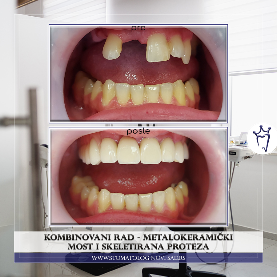 Parcijalna proteza bez kukica, komforna za nošenje i vrhunska estetika ...