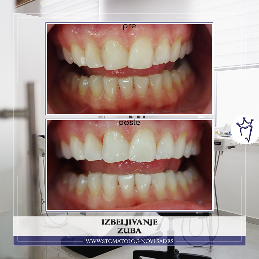 Blistavo beli zubi za samo sat vremena - Stomatolog Novi Sad - Royal ...