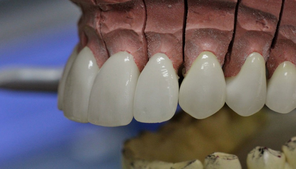 Fiksna protetika | Stomatolog Novi Sad - Royal Dental - Dr Nebojša Ničić