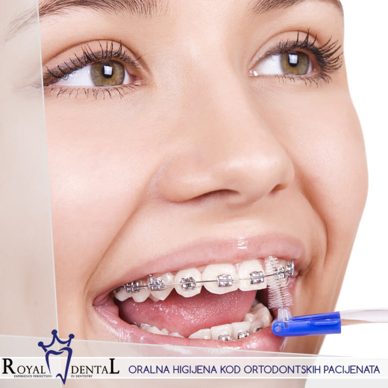 Održavanje oralne higijene za vreme nošenja fiksnog ortodontskog ...