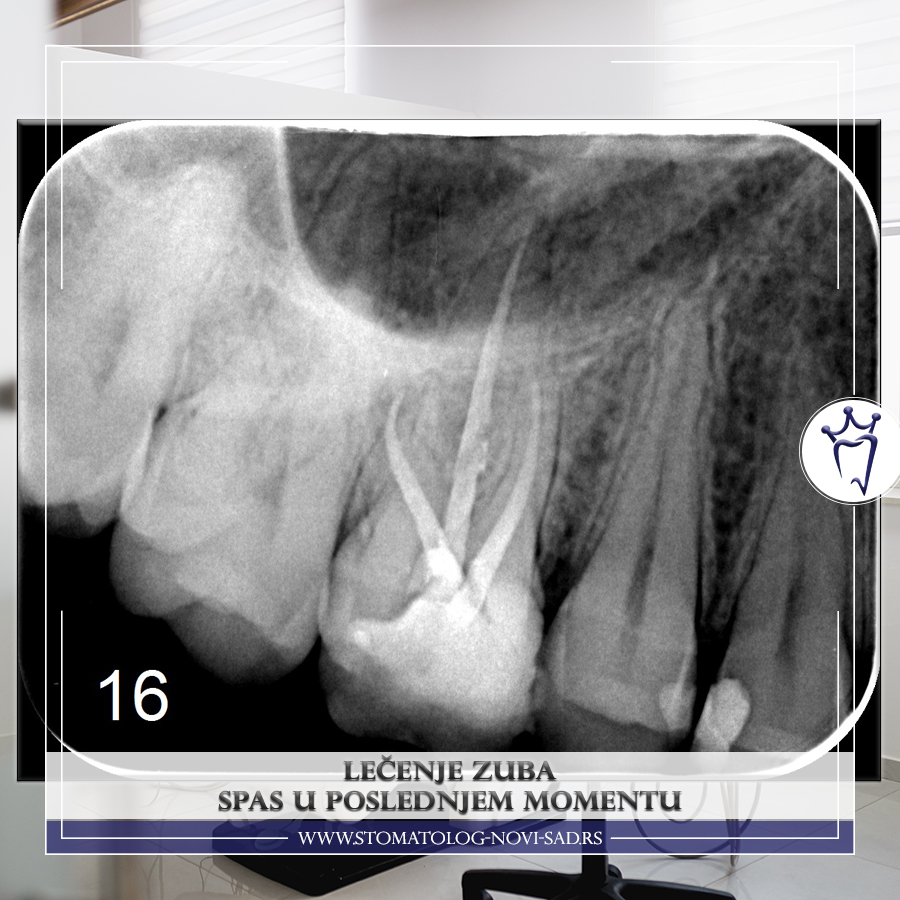 Lečenje zuba = spasavanje zuba - Stomatolog Novi Sad - Royal Dental ...