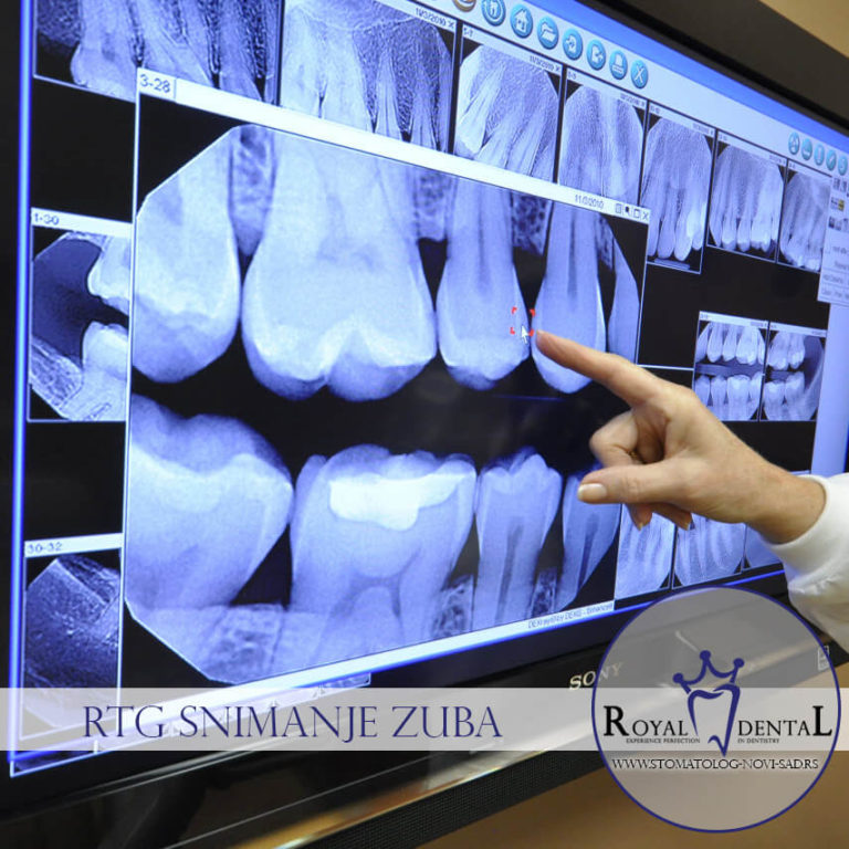 Koliko je bezbedno RTG snimanje zuba? - Stomatolog Novi Sad - Royal ...